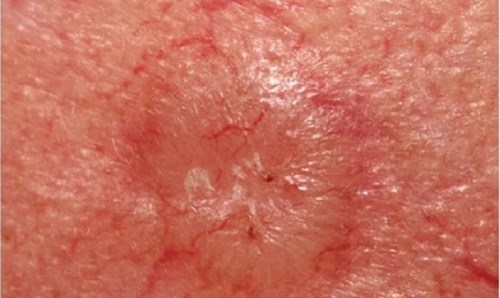 Skin cancer: signs and symptoms in older patients